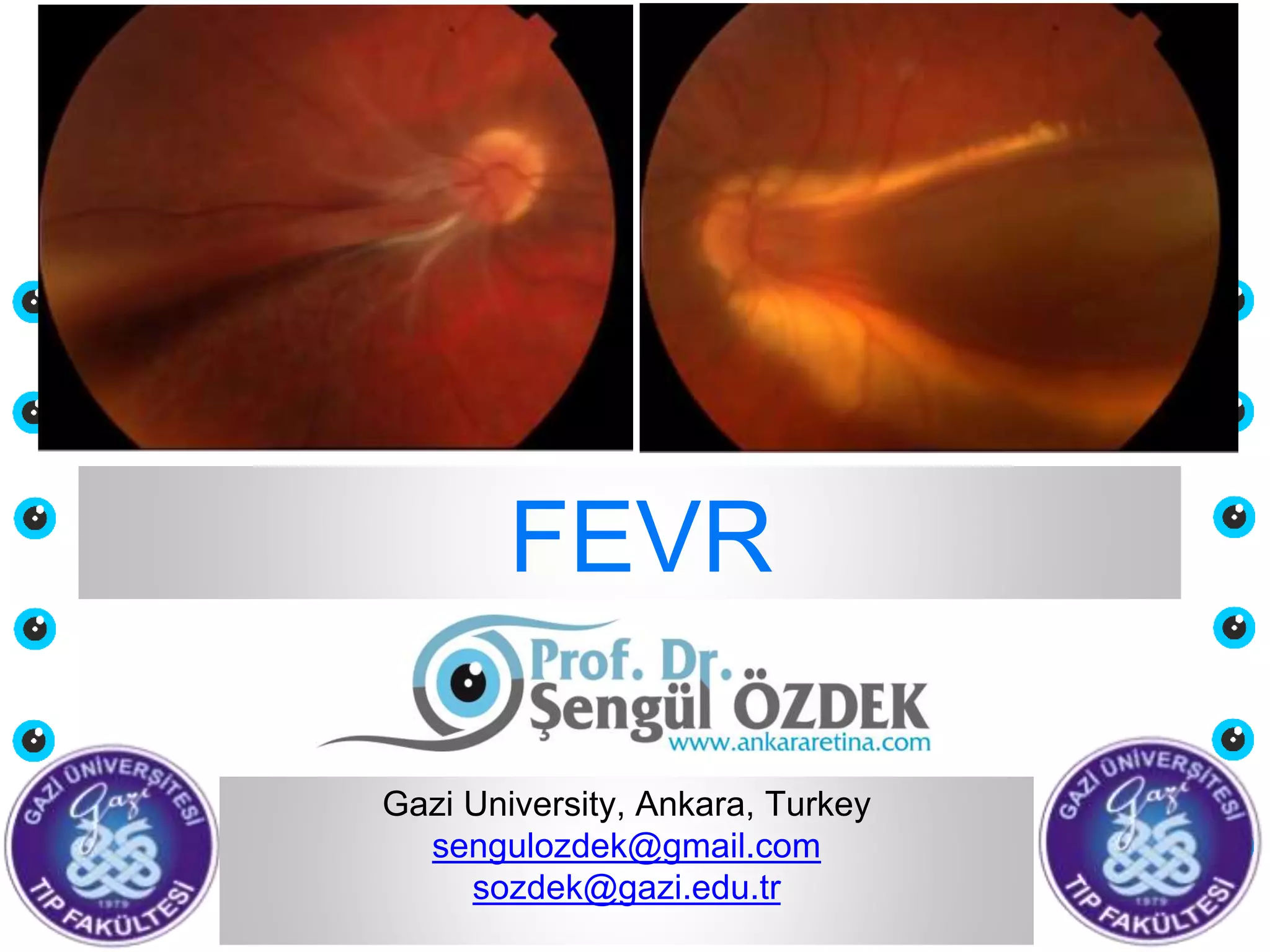 FEVR-familial exudative vitreoretinopathy.pptx