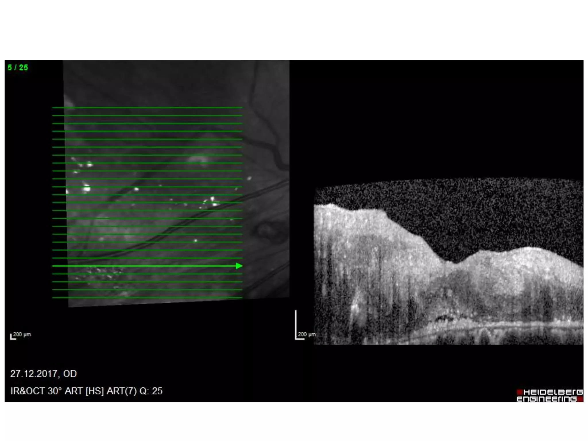 FEVR-familial exudative vitreoretinopathy.pptx