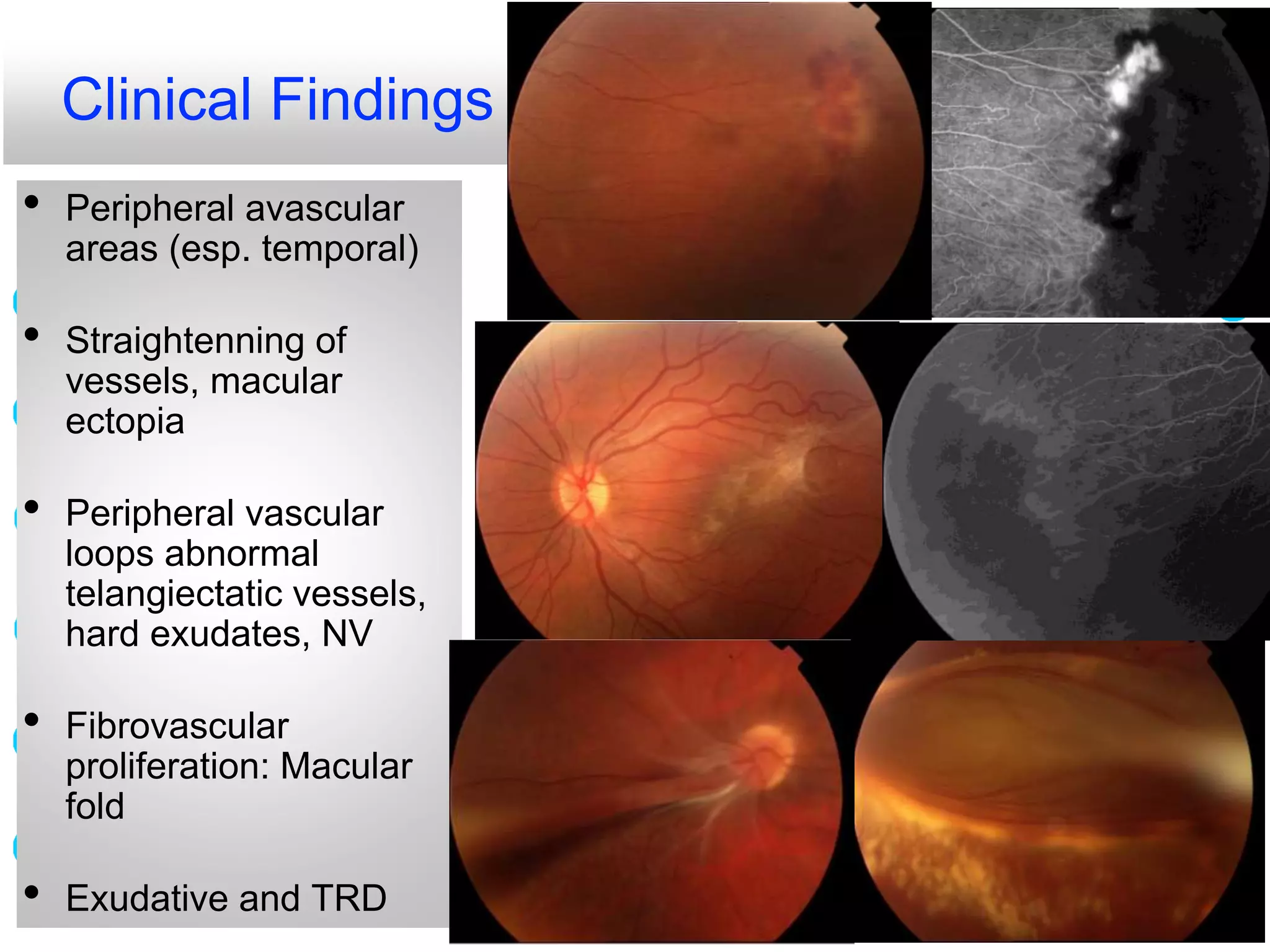 FEVR-familial exudative vitreoretinopathy.pptx