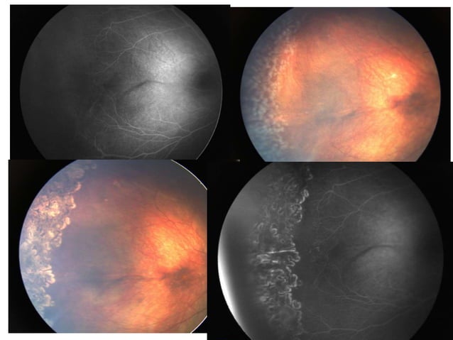 FEVR-familial exudative vitreoretinopathy.pptx