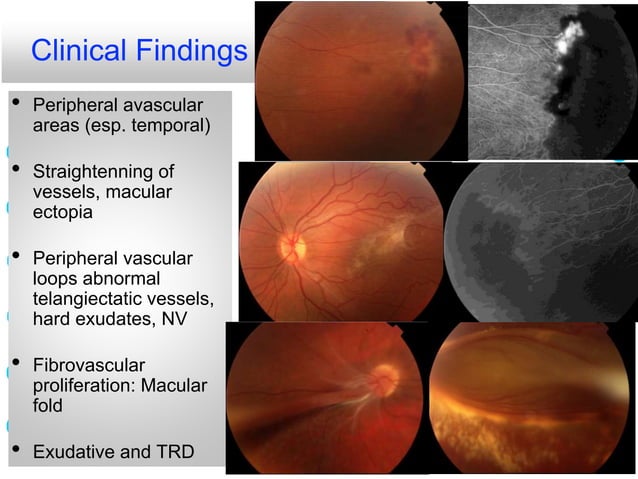 FEVR-familial exudative vitreoretinopathy.pptx