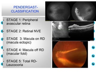 FEVR-familial exudative vitreoretinopathy.pptx