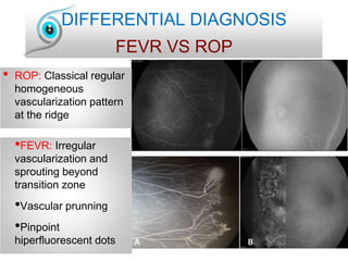 FEVR-familial exudative vitreoretinopathy.pptx