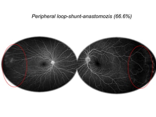 FEVR-familial exudative vitreoretinopathy.pptx