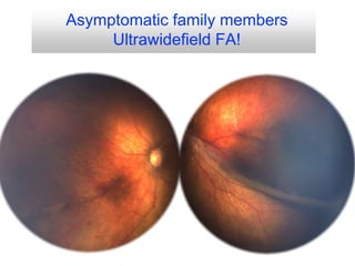FEVR-familial exudative vitreoretinopathy.pptx