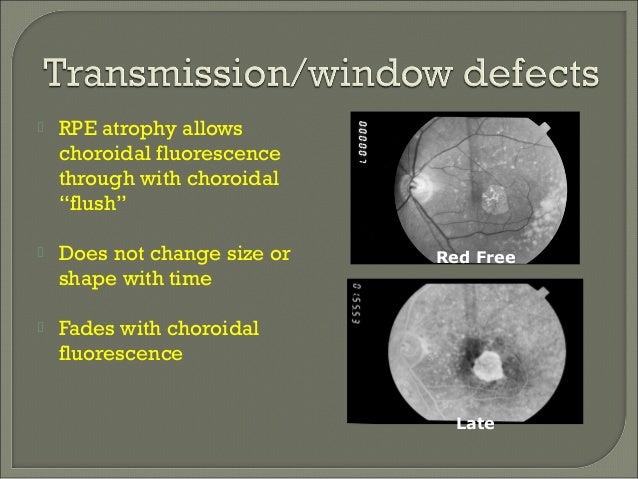 BASIC INFO ON FUDUS FLORESCENCE ANGIOGRAPHY