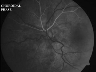 Fundus Fluoroscein Angiography | PPTX