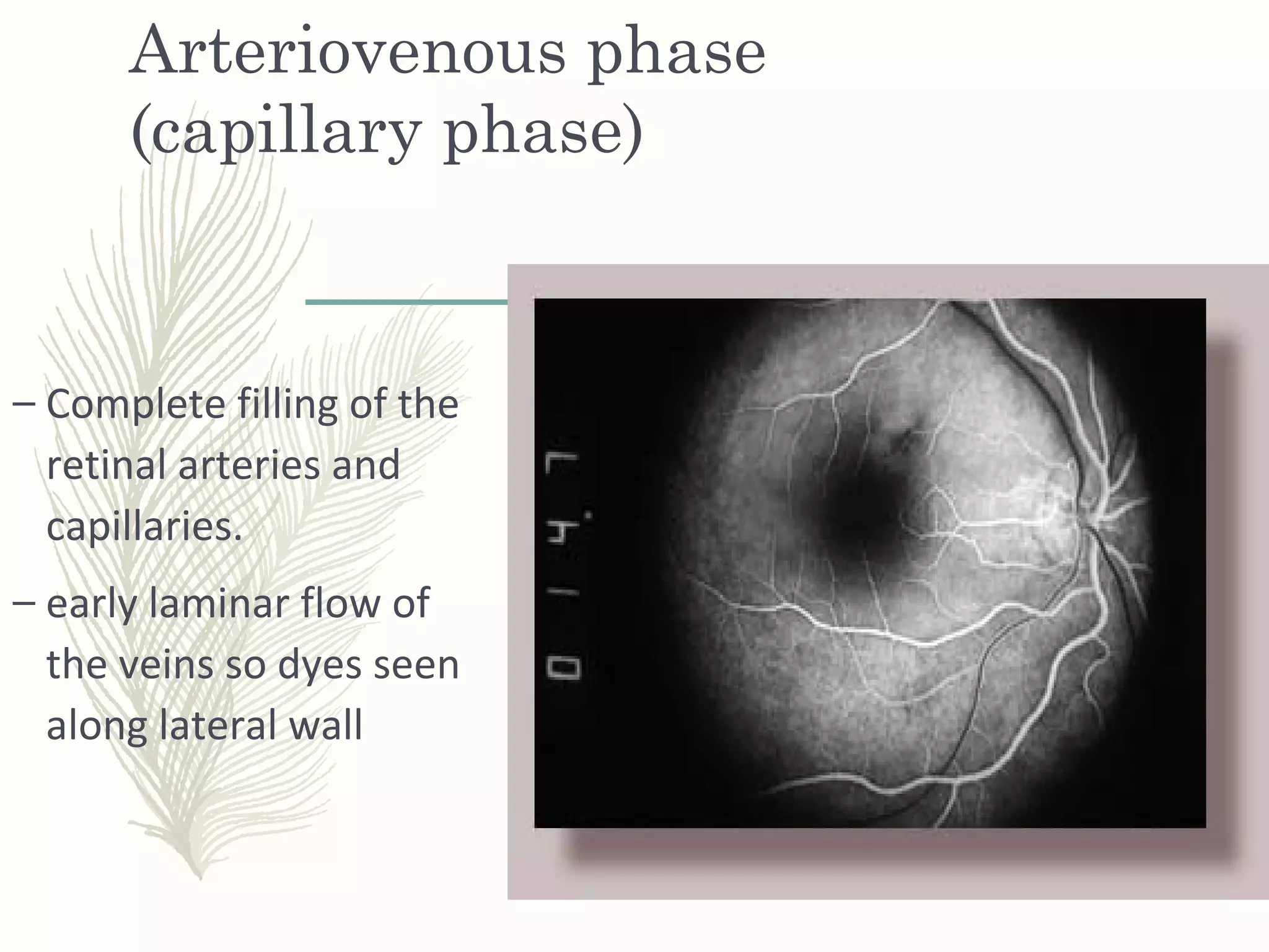 FUNDUS FLUORESCEIN ANGIOGRAPHY | PPT