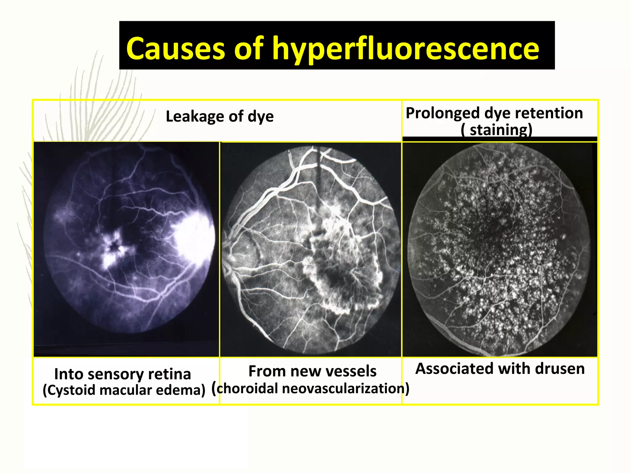 FUNDUS FLUORESCEIN ANGIOGRAPHY | PPT