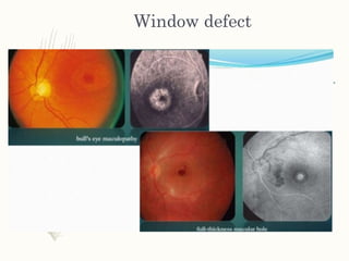 FUNDUS FLUORESCEIN ANGIOGRAPHY | PPT