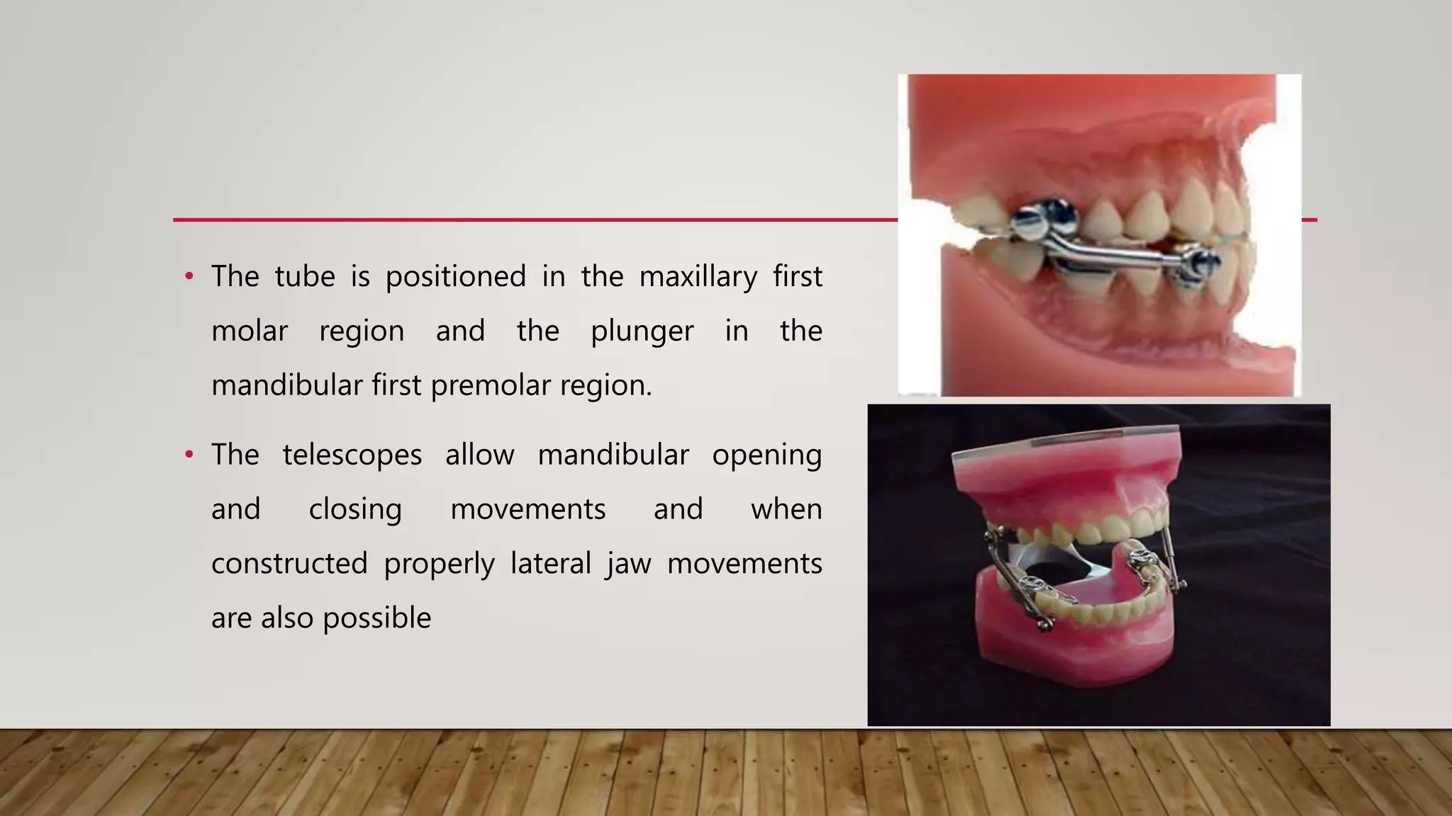 fixed functional appliances | PPTX