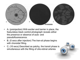 fundus flourescien angiography | PPT