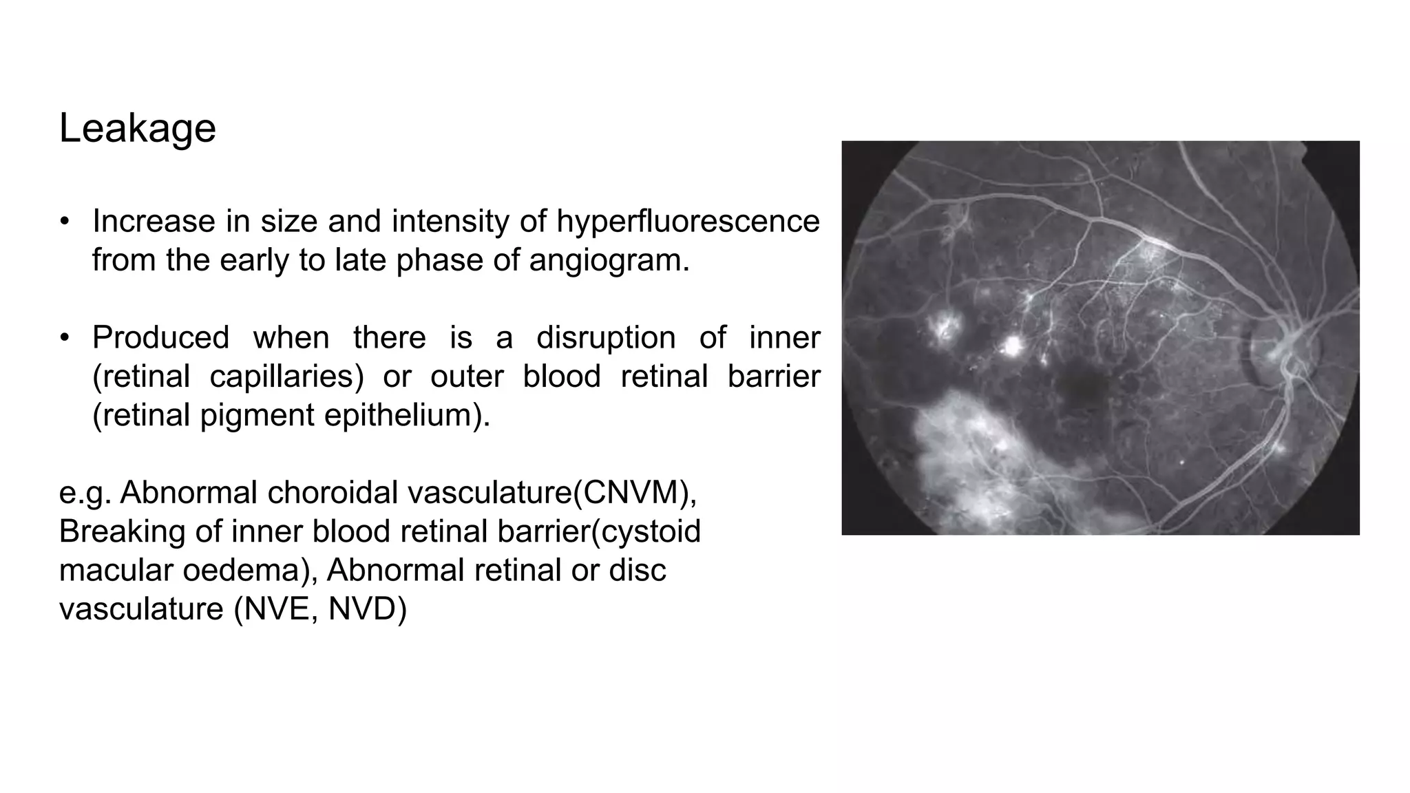 Fundus fluroscein angiography | PPTX | Eye and Vision Conditions ...