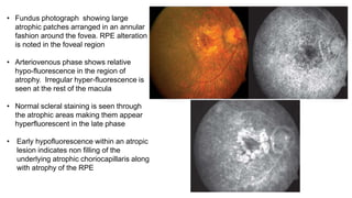 Fundus fluroscein angiography | PPTX