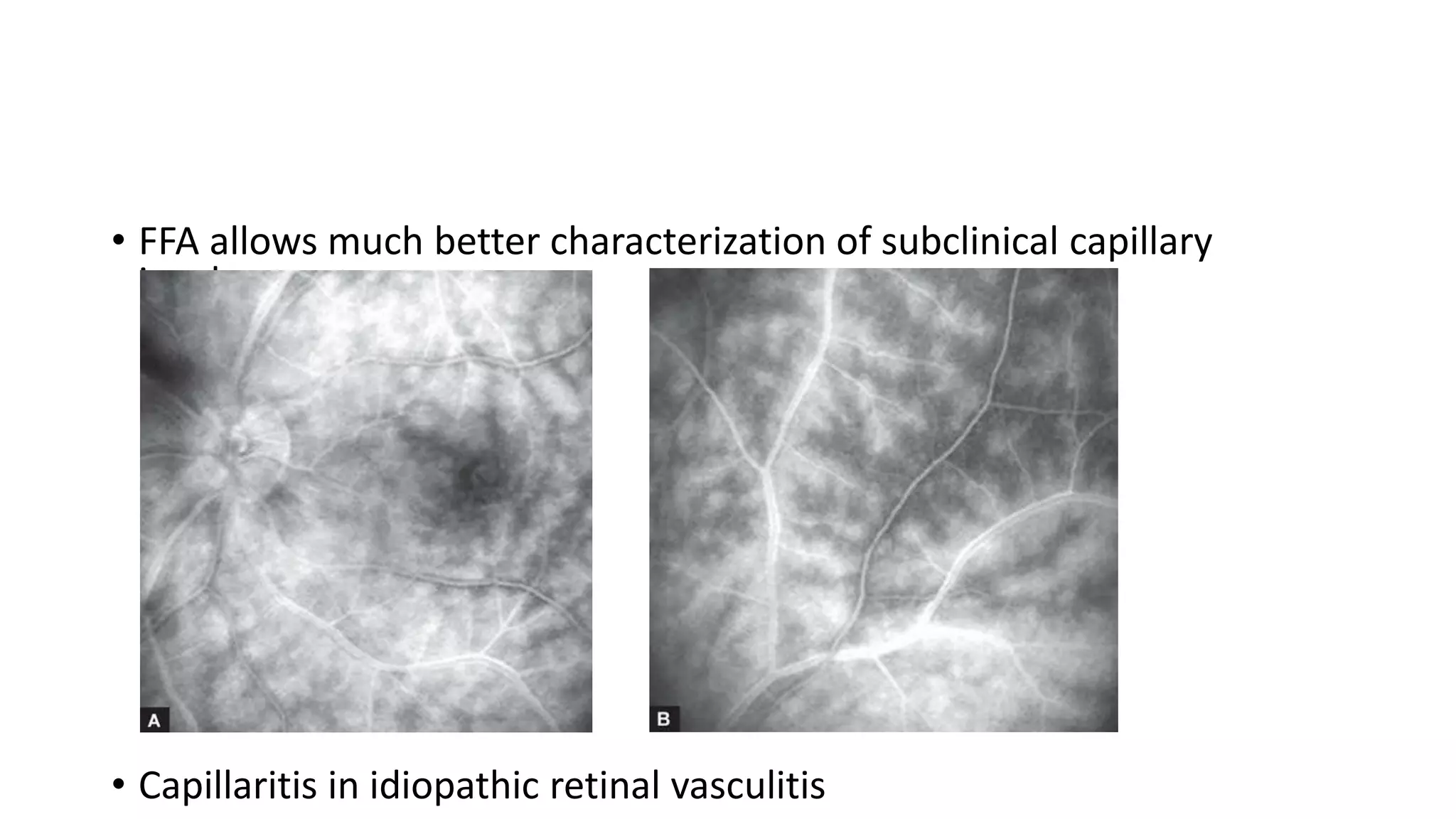 FFA and ICGA in posterior uveitis | PPTX