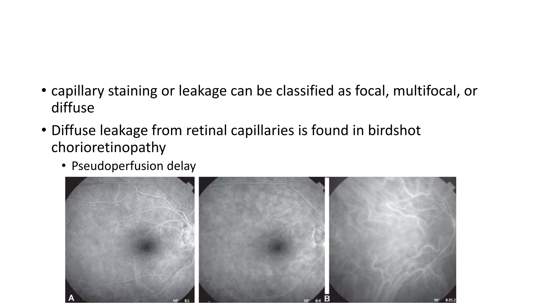 FFA and ICGA in posterior uveitis | PPTX
