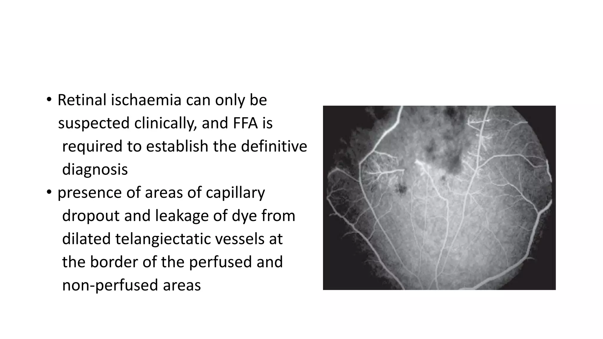 FFA and ICGA in posterior uveitis | PPTX
