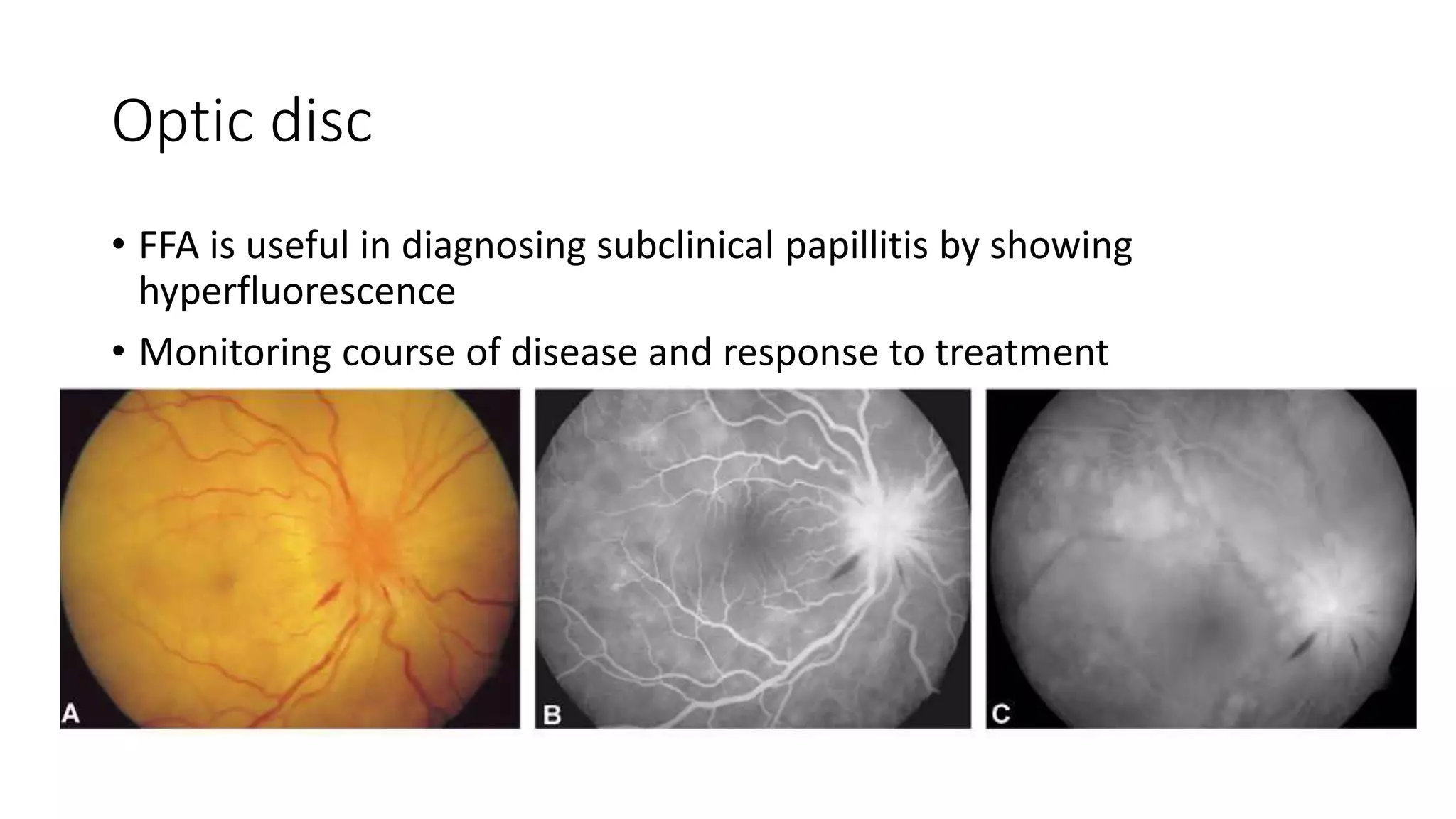 FFA and ICGA in posterior uveitis | PPTX
