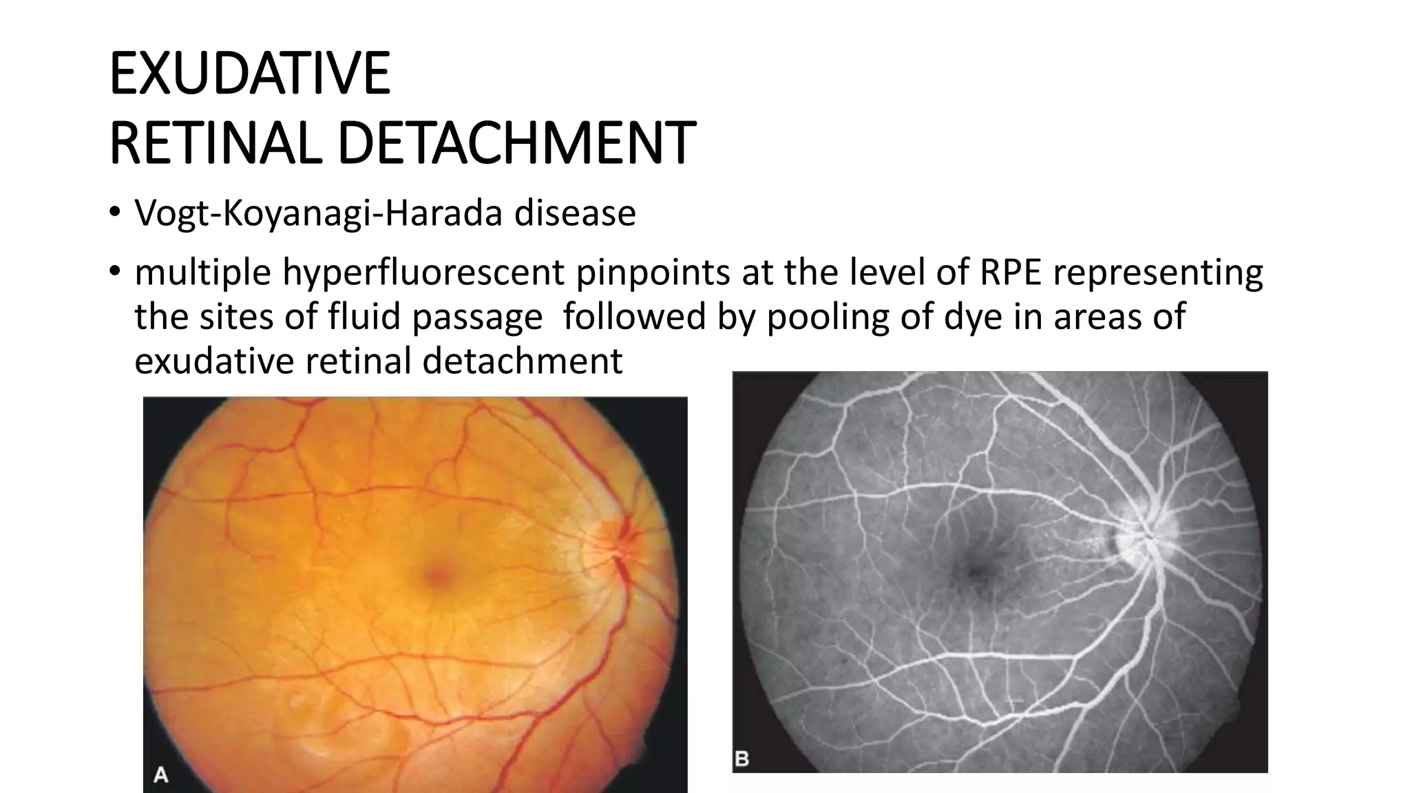 FFA and ICGA in posterior uveitis | PPTX