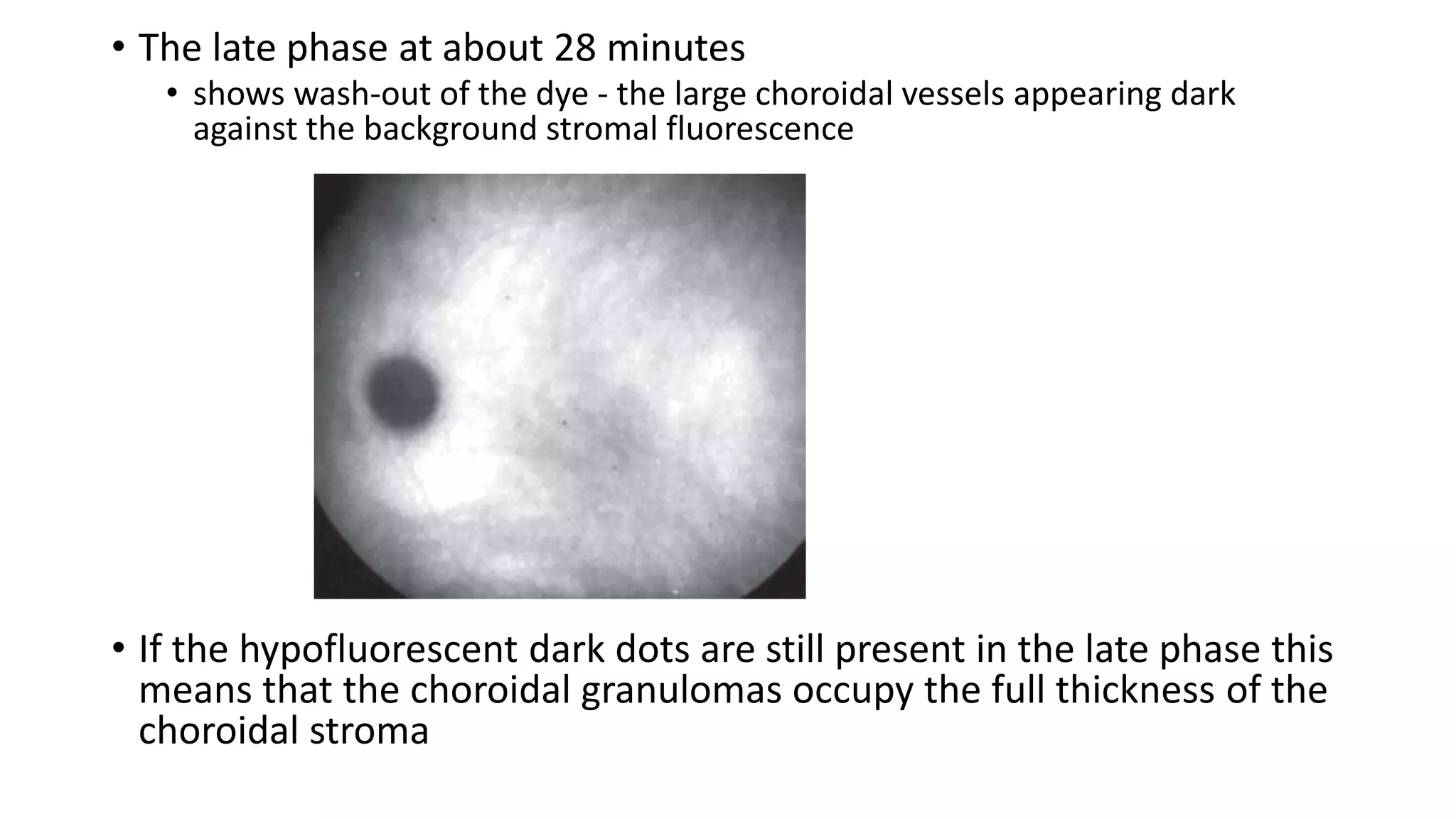 FFA and ICGA in posterior uveitis | PPTX