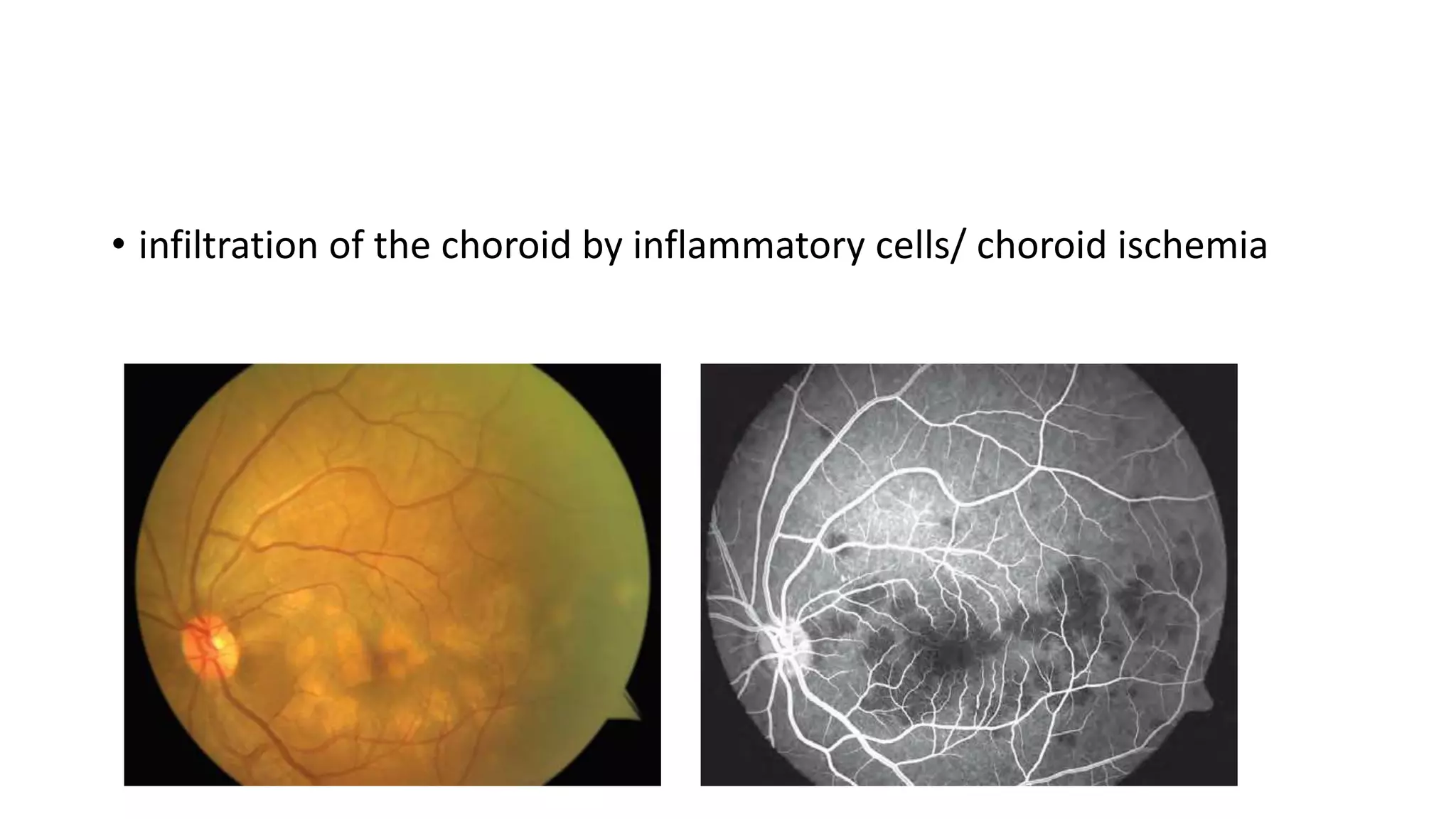 FFA and ICGA in posterior uveitis | PPTX
