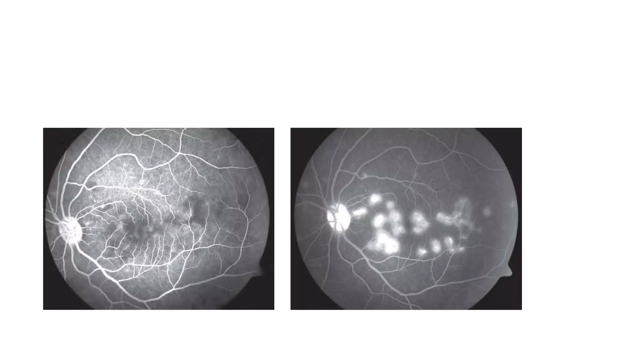 FFA and ICGA in posterior uveitis | PPTX
