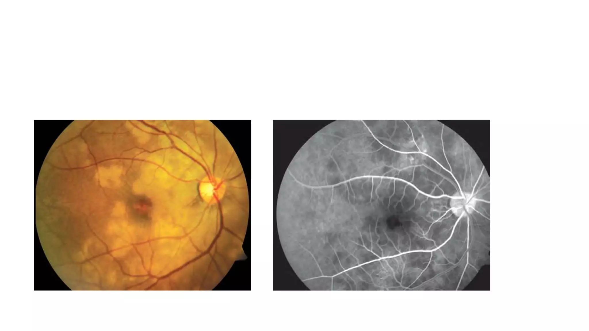 FFA and ICGA in posterior uveitis | PPTX
