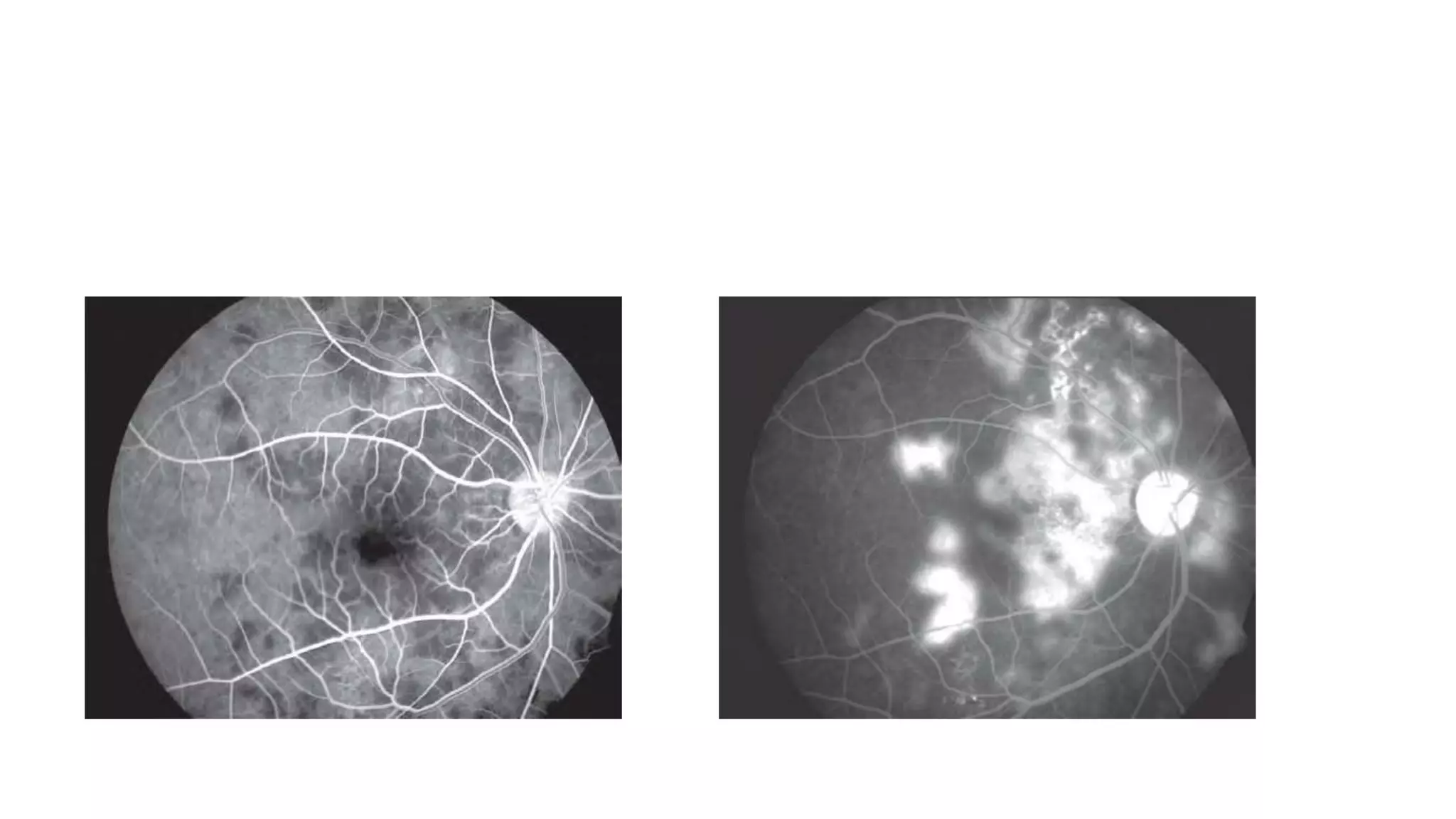 FFA and ICGA in posterior uveitis | PPTX