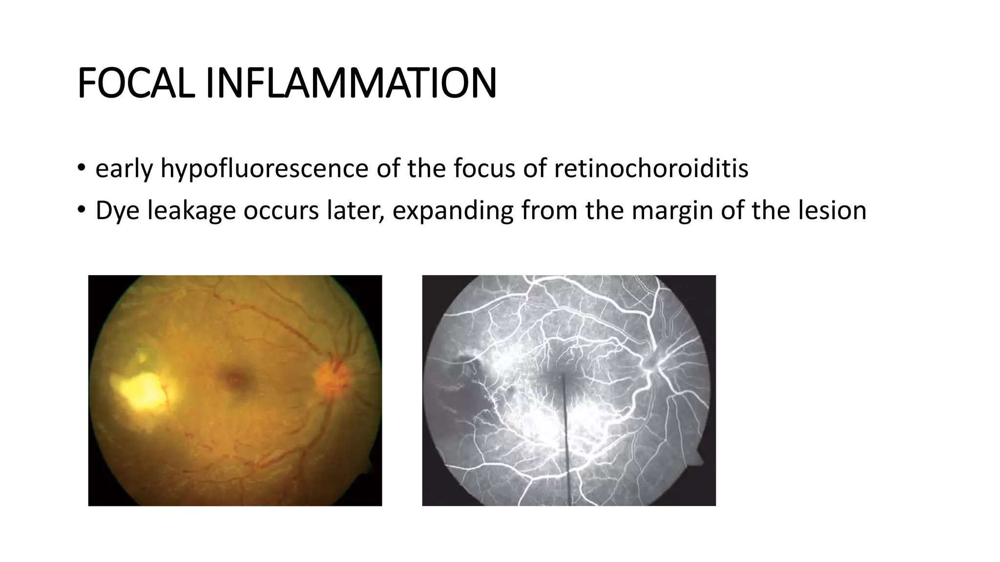 FFA and ICGA in posterior uveitis | PPTX