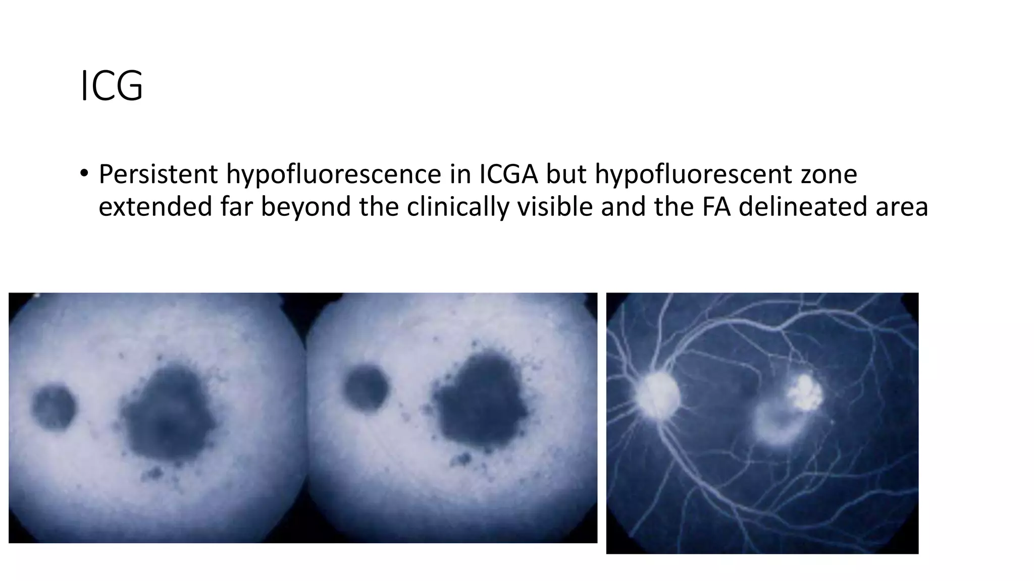 FFA and ICGA in posterior uveitis | PPTX