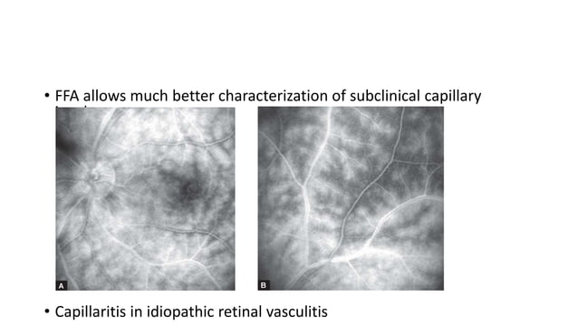 FFA and ICGA in posterior uveitis | PPTX
