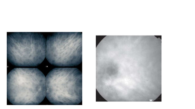 FFA and ICGA in posterior uveitis | PPTX