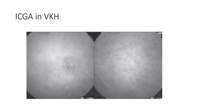 FFA and ICGA in posterior uveitis | PPTX