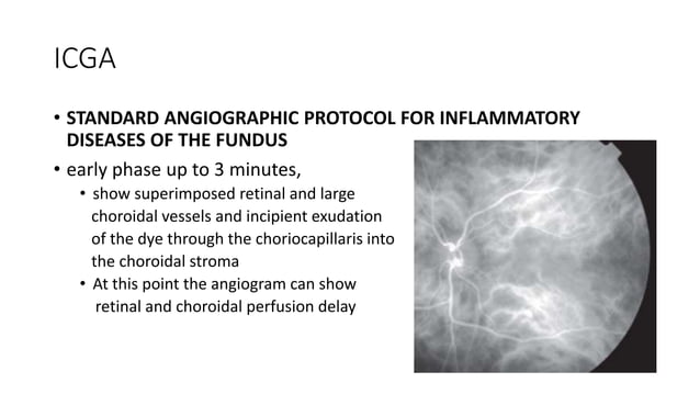 FFA and ICGA in posterior uveitis | PPTX