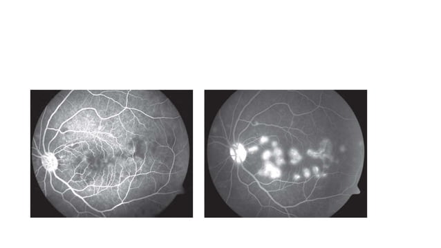 FFA and ICGA in posterior uveitis | PPTX