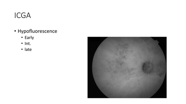 FFA and ICGA in posterior uveitis | PPTX
