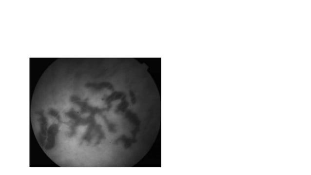FFA and ICGA in posterior uveitis | PPTX