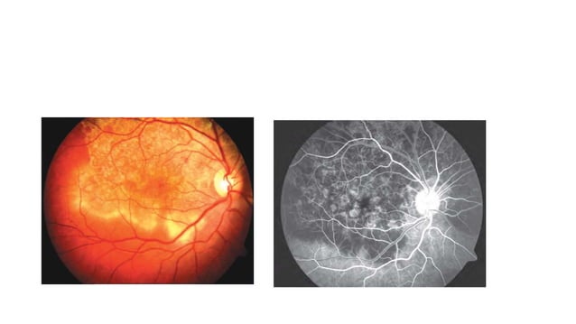FFA and ICGA in posterior uveitis | PPTX
