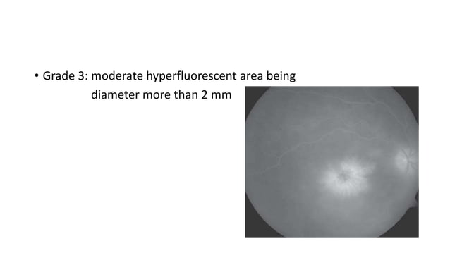 FFA and ICGA in posterior uveitis | PPTX