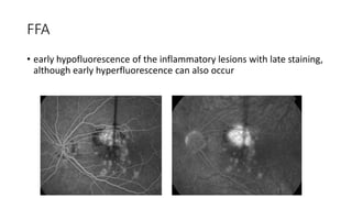 FFA and ICGA in posterior uveitis | PPTX