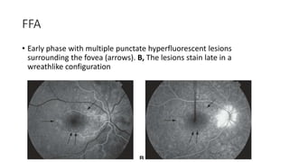 FFA and ICGA in posterior uveitis | PPTX