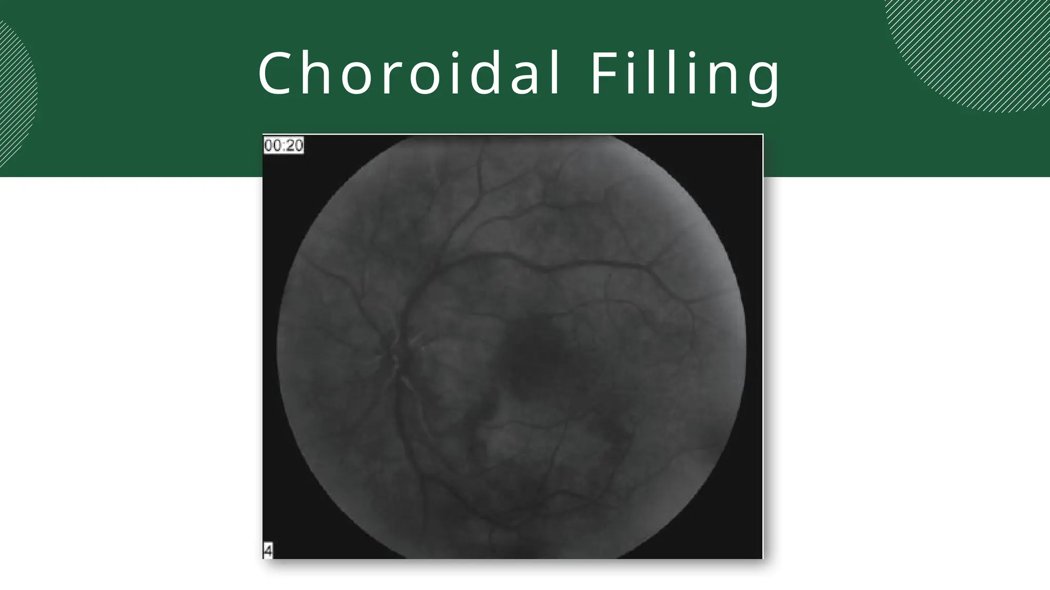 Pemeriksaan Fundus Fluorescein Angiography | PPTX