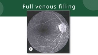 Pemeriksaan Fundus Fluorescein Angiography | PPTX