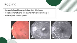 Pemeriksaan Fundus Fluorescein Angiography | PPTX