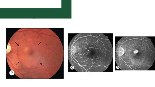 Pemeriksaan Fundus Fluorescein Angiography | PPTX