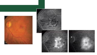 Pemeriksaan Fundus Fluorescein Angiography | PPTX
