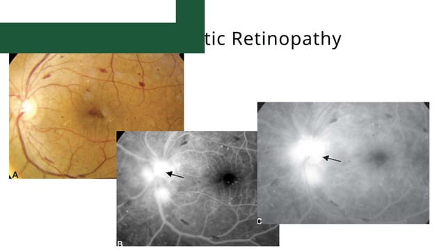 Pemeriksaan Fundus Fluorescein Angiography | PPTX