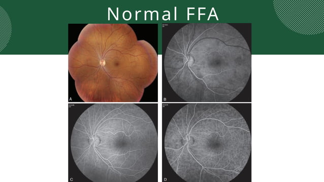 Pemeriksaan Fundus Fluorescein Angiography | PPTX