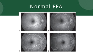 Pemeriksaan Fundus Fluorescein Angiography | PPTX