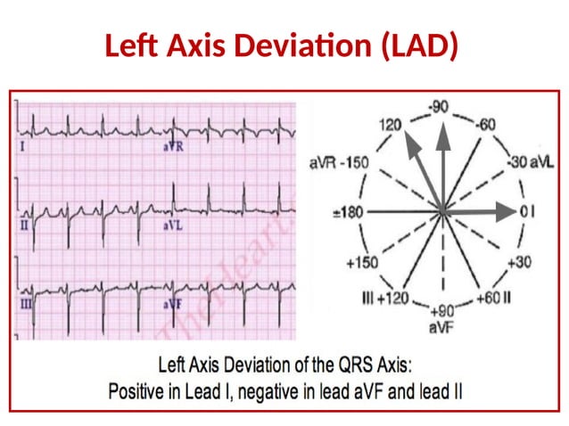 lecture on cardiac Axis on ecg for nurses | PPT